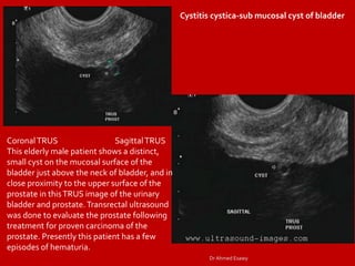 Imaging cystitis Dr Ahmed Esawy | PDF