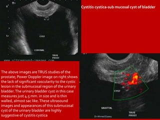 Imaging cystitis Dr Ahmed Esawy | PDF