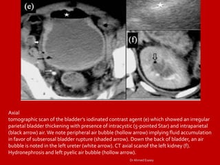 Imaging cystitis Dr Ahmed Esawy | PDF