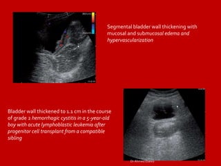 Imaging cystitis Dr Ahmed Esawy | PDF