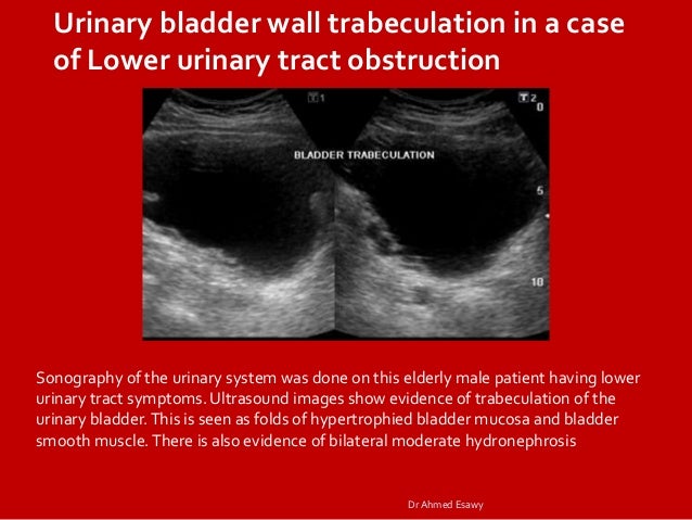 Imaging cystitis Dr Ahmed Esawy