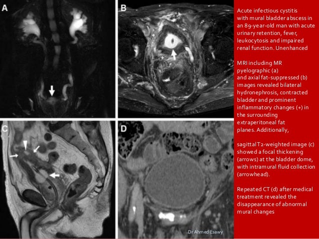 Imaging cystitis Dr Ahmed Esawy