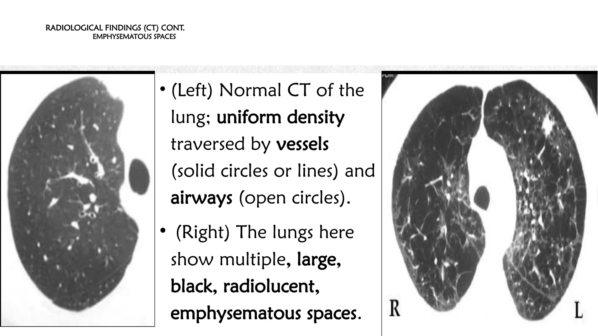 Radiographic Imaging findings of COPD on Conventional X-ray and CT | PPTX