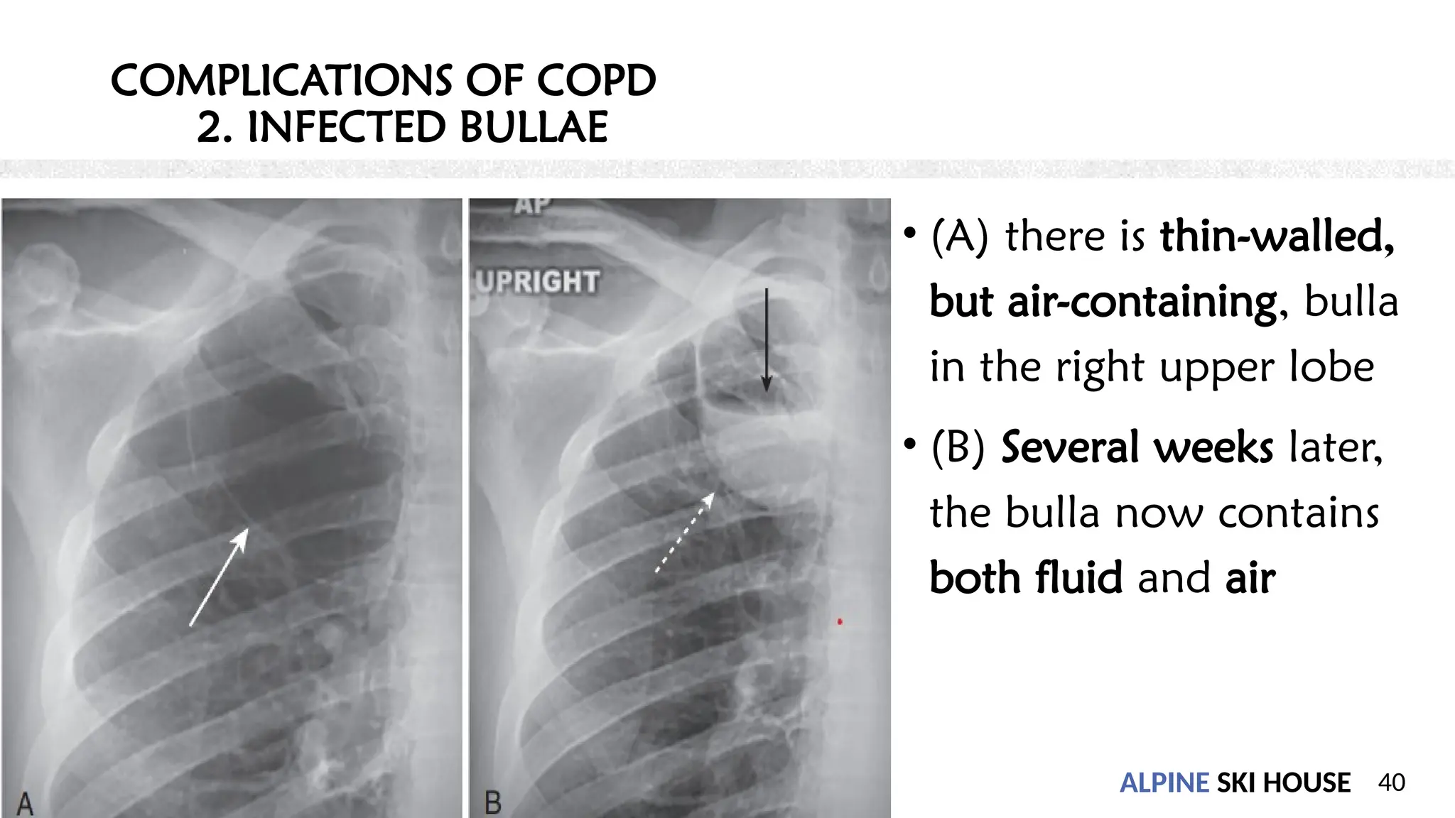 Radiographic Imaging findings of COPD on Conventional X-ray and CT | PPTX