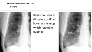 Radiographic Imaging findings of COPD on Conventional X-ray and CT | PPTX