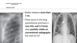 Radiographic Imaging findings of COPD on Conventional X-ray and CT | PPTX