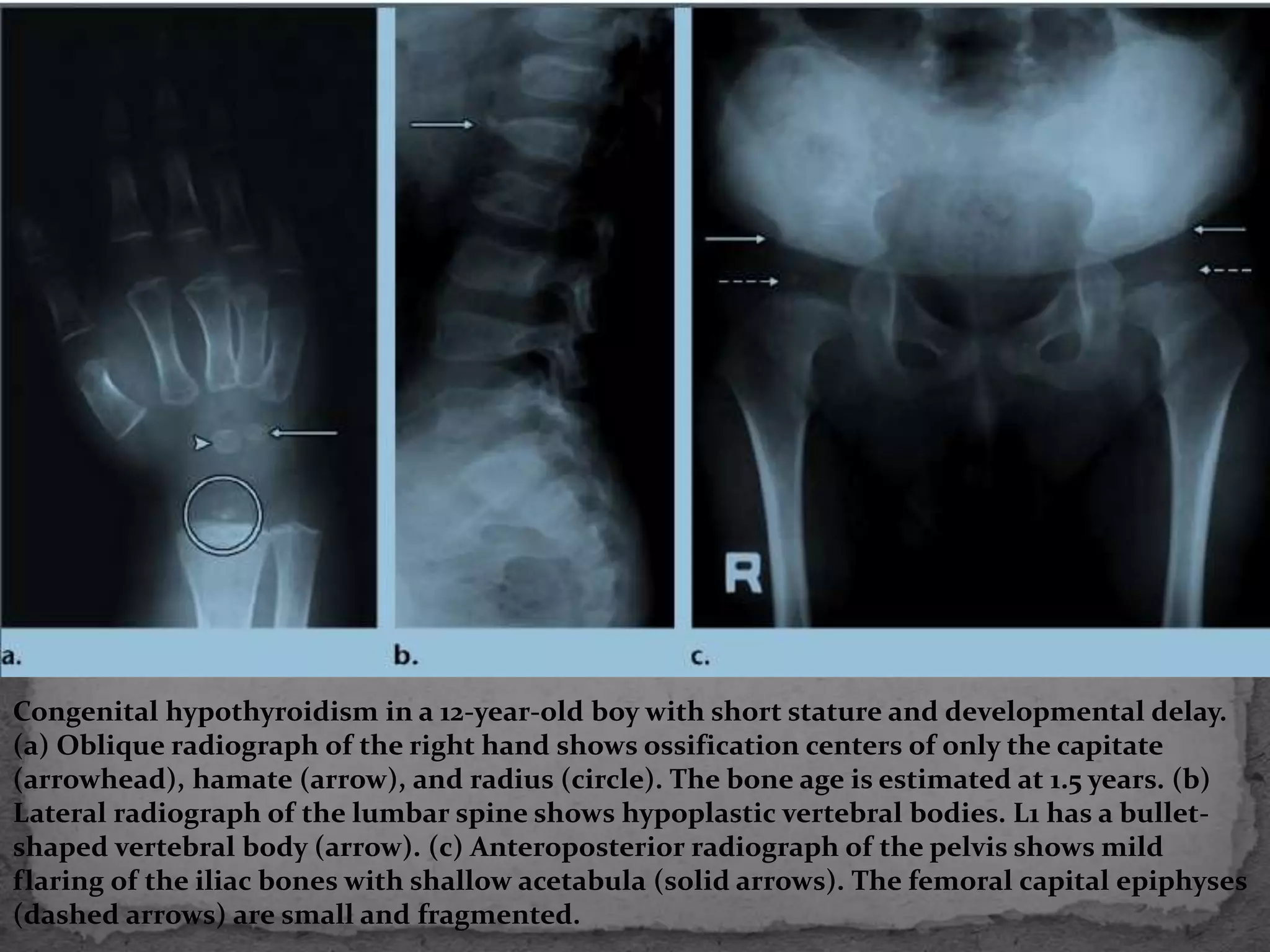Imaging findings of metabolic bone diseases | PPTX | Death, Injury, or ...