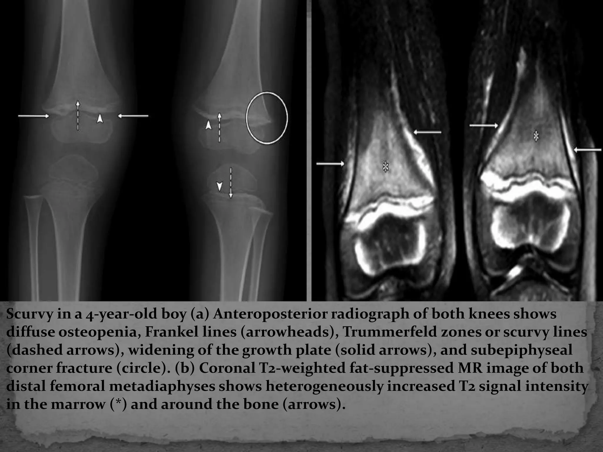 Imaging findings of metabolic bone diseases | PPTX