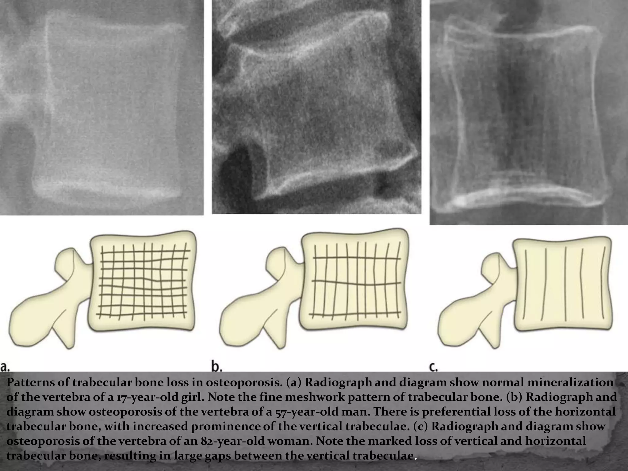 Imaging findings of metabolic bone diseases | PPTX