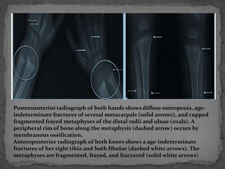 Imaging findings of metabolic bone diseases | PPTX