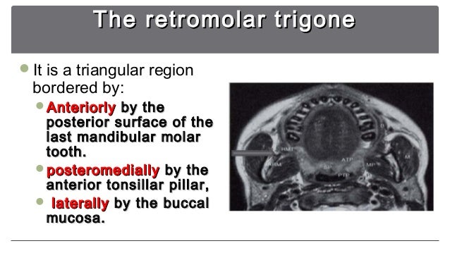 Retromolar Region