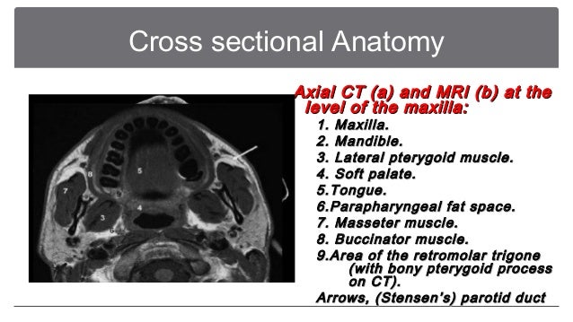 Retromolar Trigone Ct
