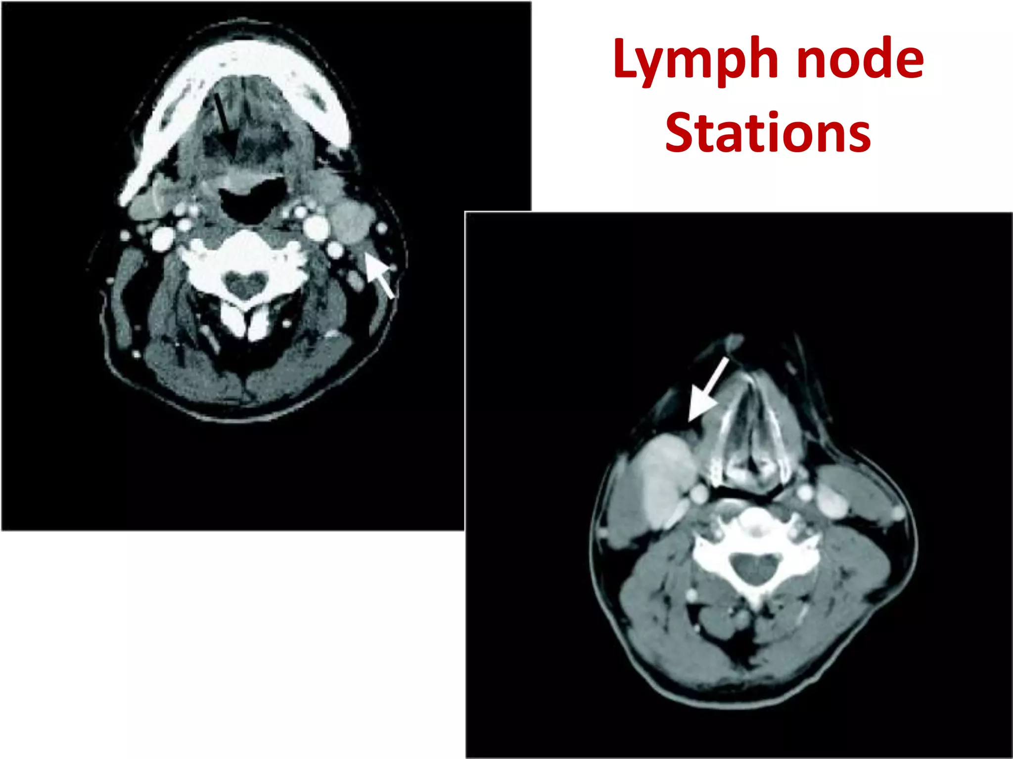Imaging HNF(head neck and face) -cancer | PPTX