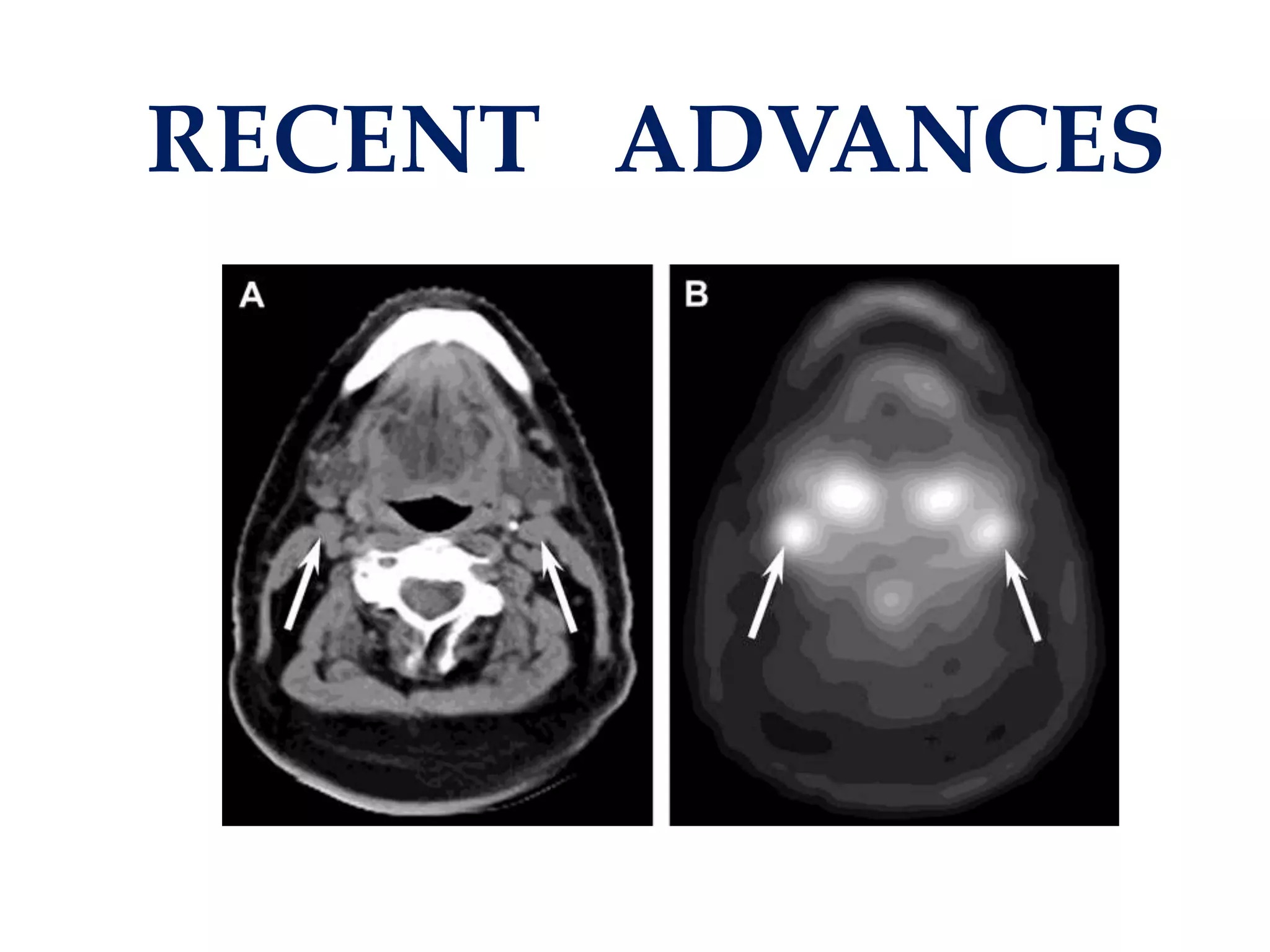 Imaging HNF(head neck and face) -cancer | PPTX