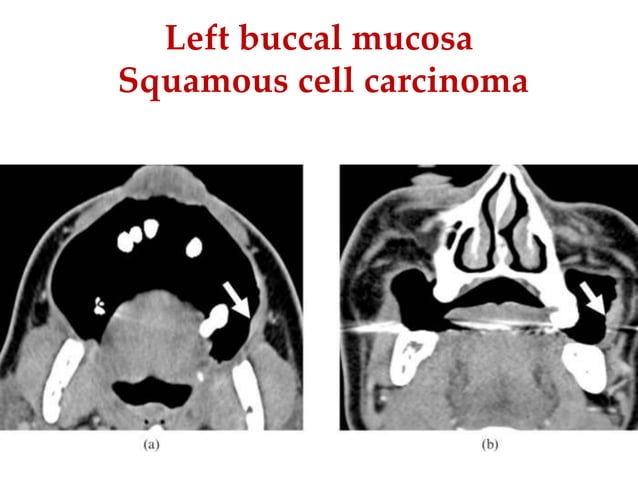 Imaging HNF(head neck and face) -cancer | PPTX | Cancer | Diseases and ...