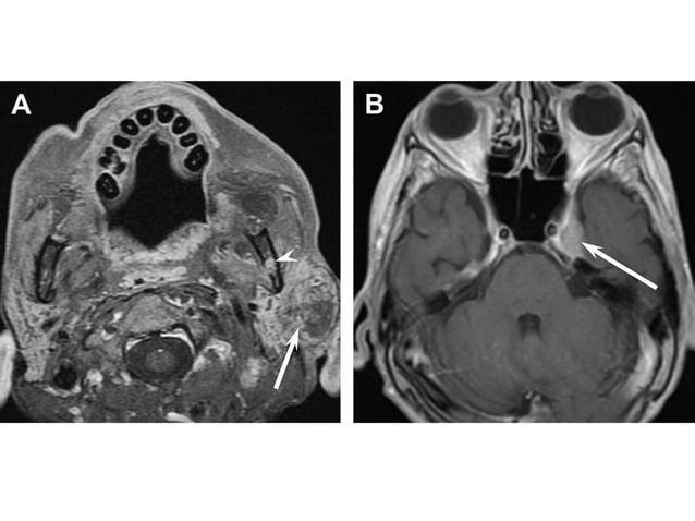 Imaging HNF(head neck and face) -cancer | PPTX | Cancer | Diseases and ...