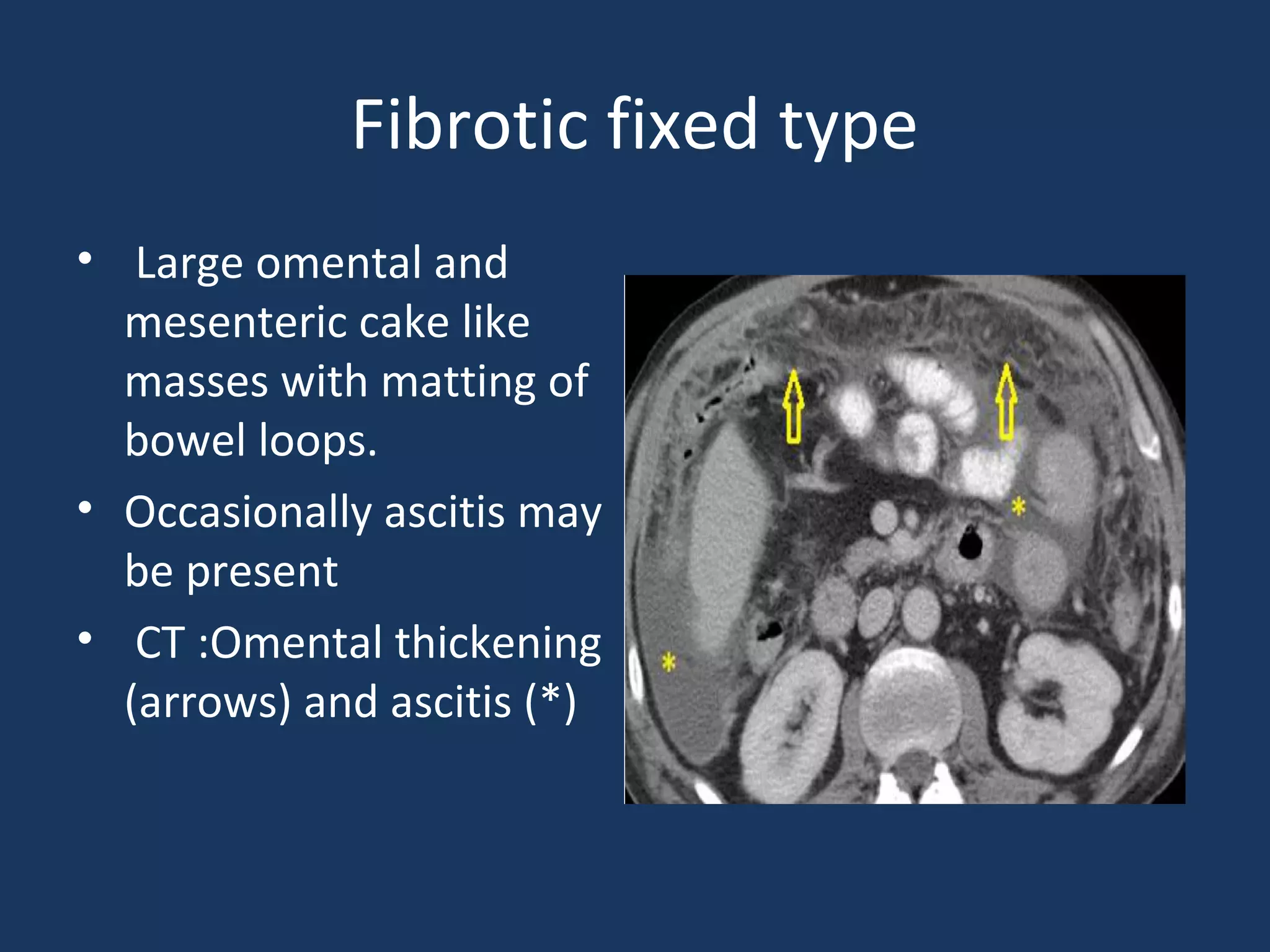 IMAGING IN ABDOMINAL TUBERCULOSIS | PPT