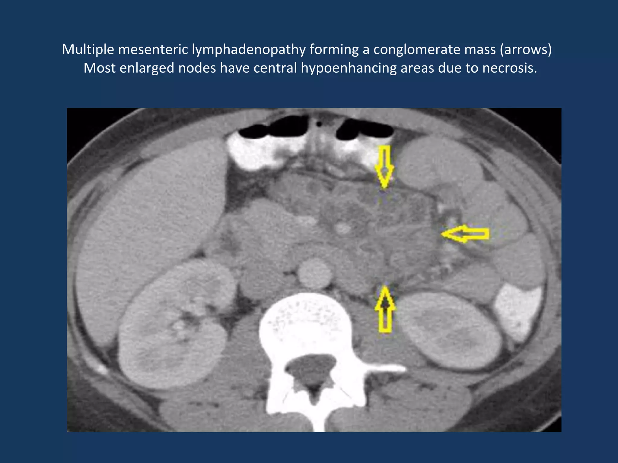 IMAGING IN ABDOMINAL TUBERCULOSIS | PPT