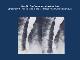 Hourglass Stomach X Ray