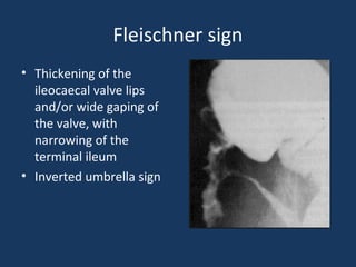 IMAGING IN ABDOMINAL TUBERCULOSIS | PPT