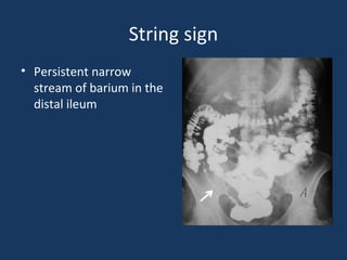 IMAGING IN ABDOMINAL TUBERCULOSIS | PPT