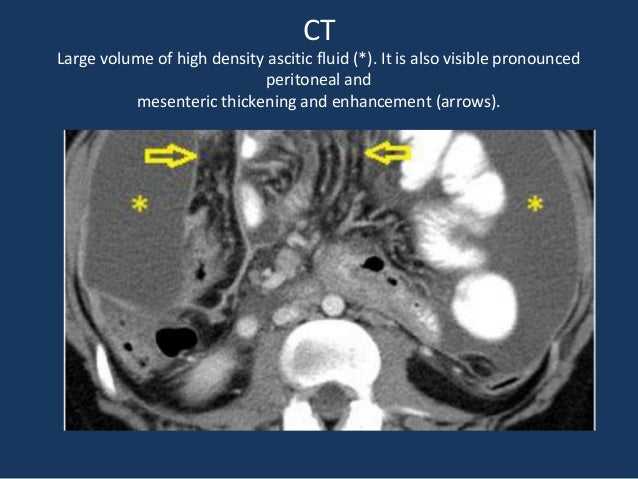 IMAGING IN ABDOMINAL TUBERCULOSIS