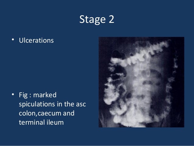IMAGING IN ABDOMINAL TUBERCULOSIS