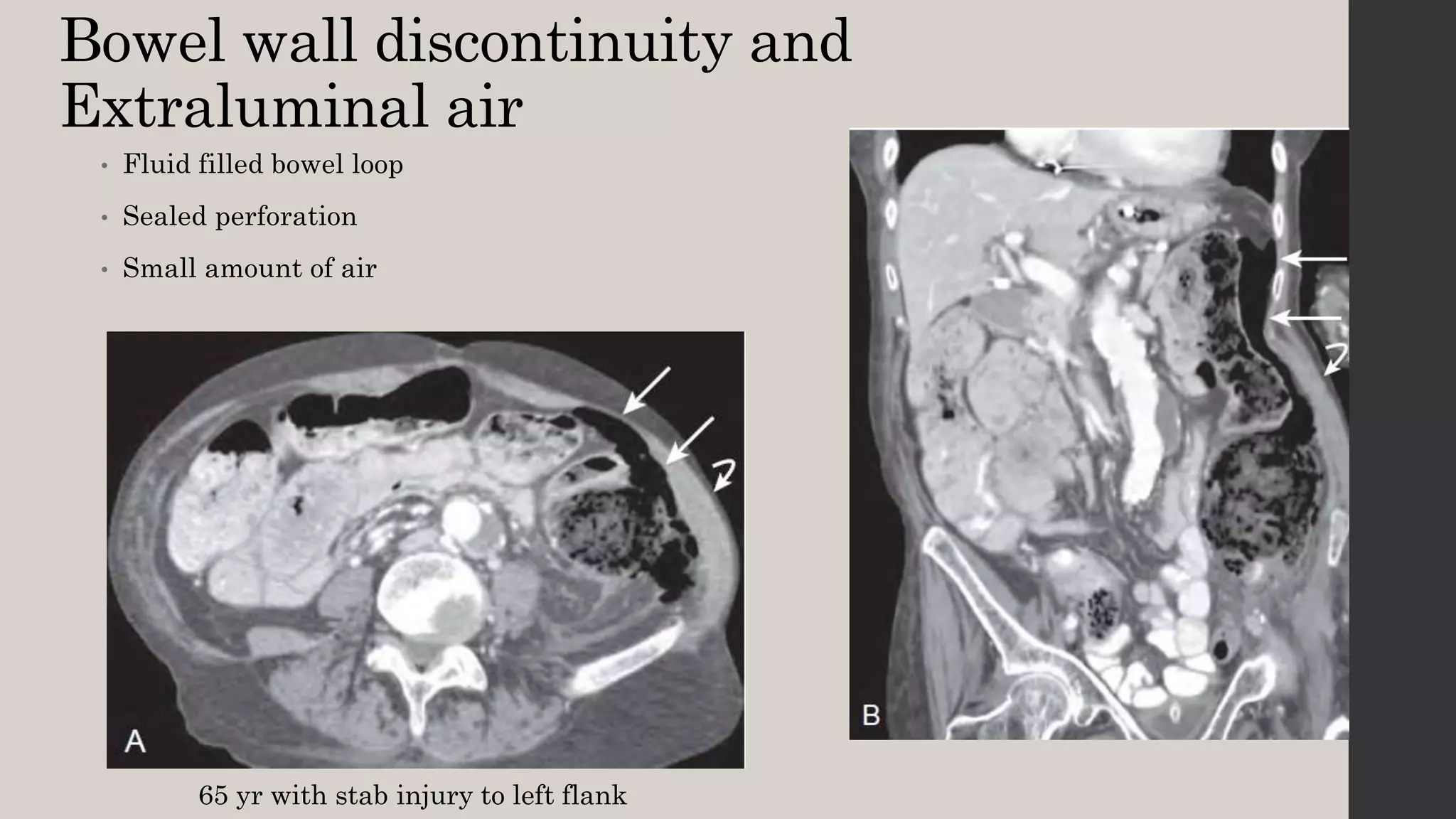 Bowel and mesenteric injury | PPTX