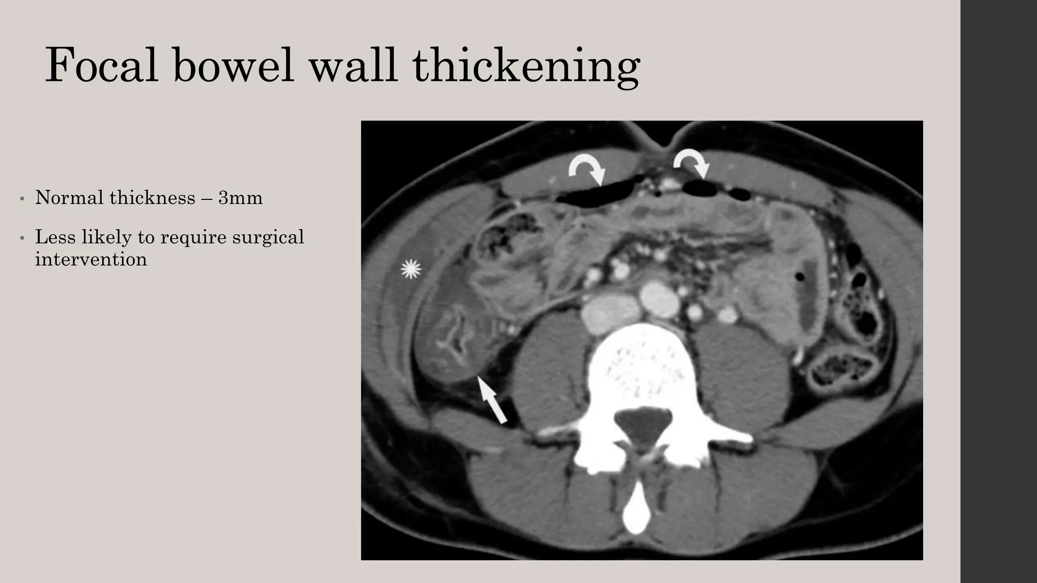 Bowel and mesenteric injury | PPTX