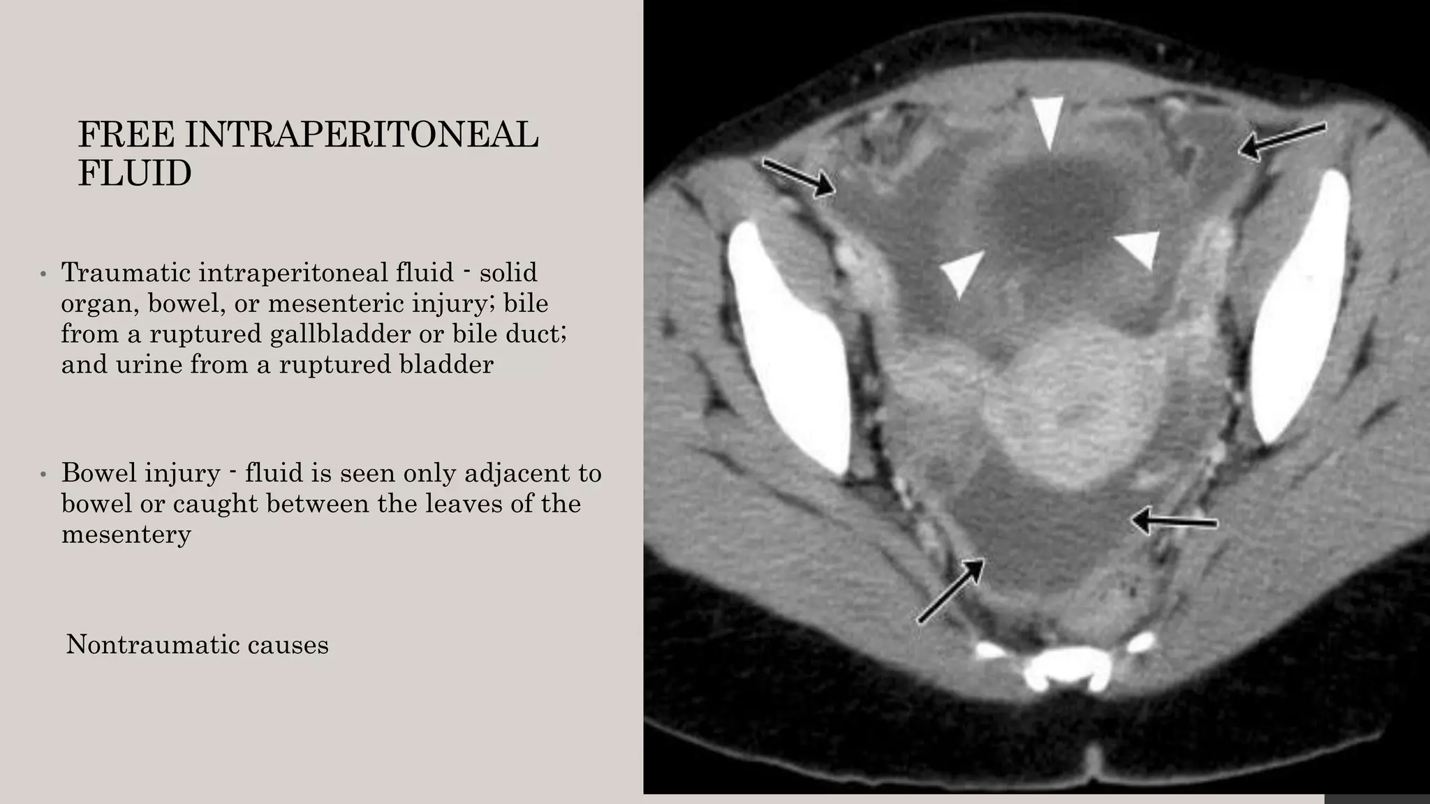 Bowel and mesenteric injury | PPTX
