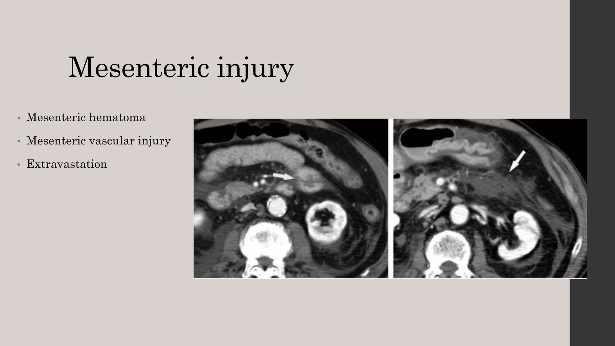 Bowel and mesenteric injury | PPTX