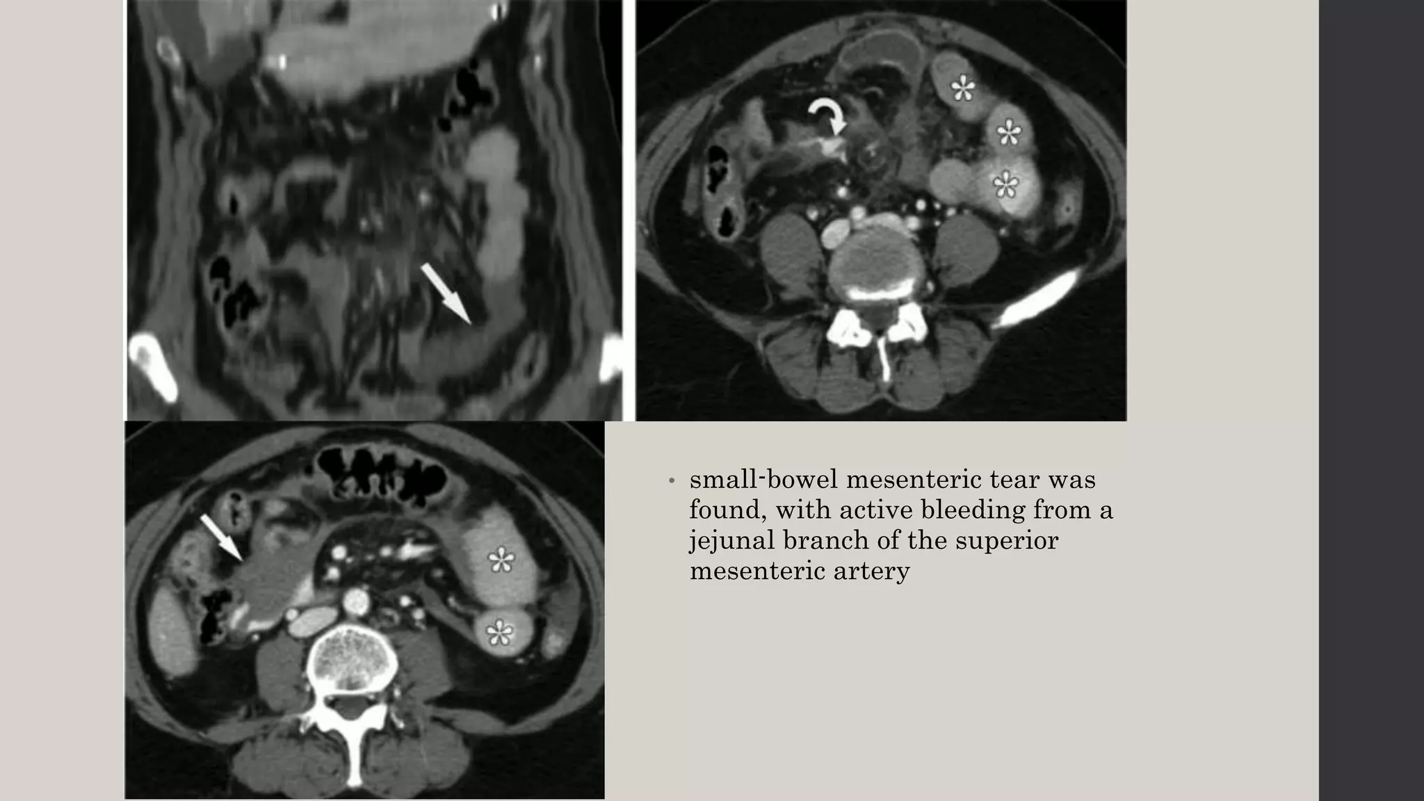 Bowel and mesenteric injury | PPTX