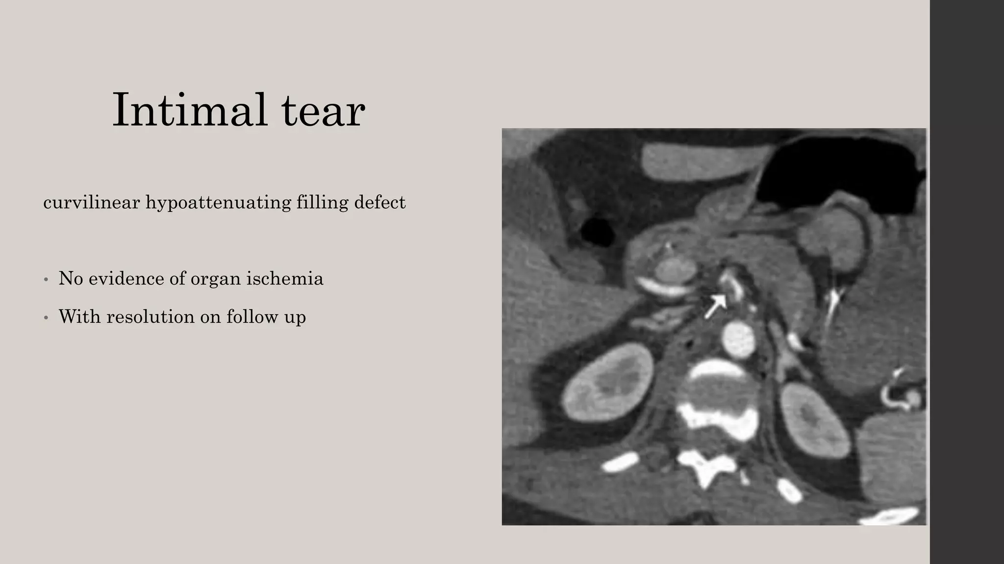 Bowel and mesenteric injury | PPTX