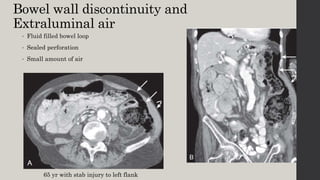 Bowel and mesenteric injury | PPTX