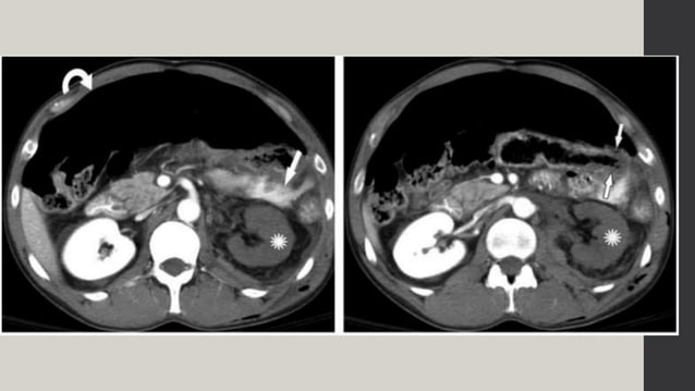 Bowel and mesenteric injury | PPTX