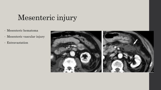 Bowel and mesenteric injury | PPTX