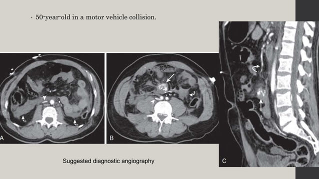 Bowel and mesenteric injury | PPTX