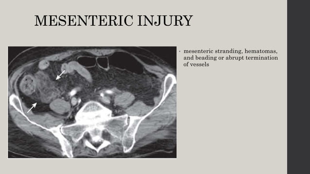 Bowel and mesenteric injury | PPTX