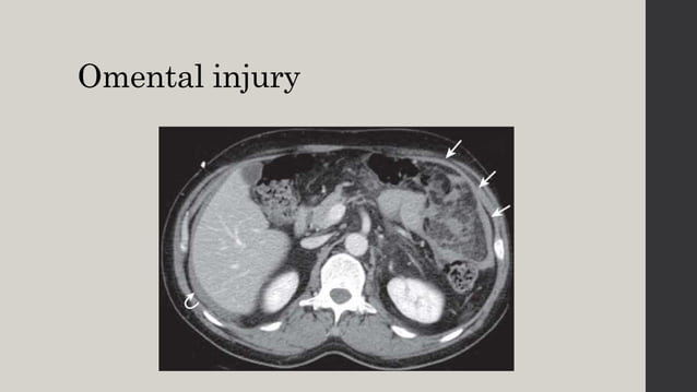 Bowel and mesenteric injury | PPTX