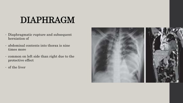 Bowel and mesenteric injury | PPTX