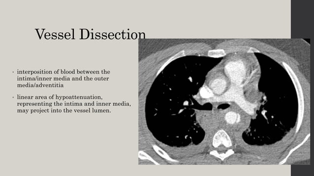 Bowel and mesenteric injury | PPTX