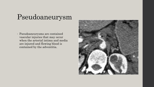 Bowel and mesenteric injury | PPTX