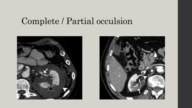 Bowel and mesenteric injury | PPTX