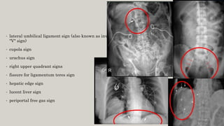 Bowel and mesenteric injury | PPTX