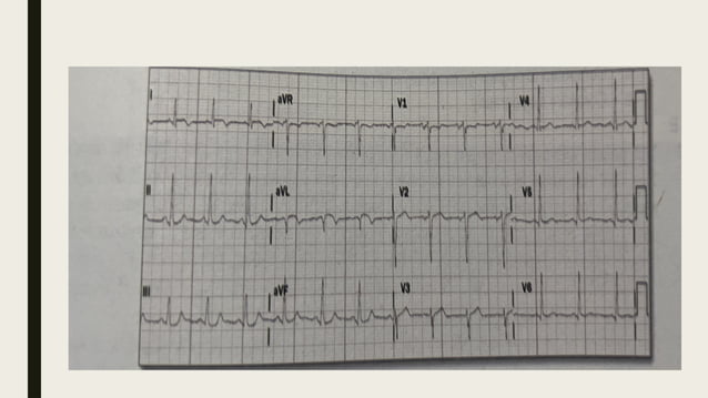 imaging in ACS by Sia.pptx acute coronary syndrome | PPT