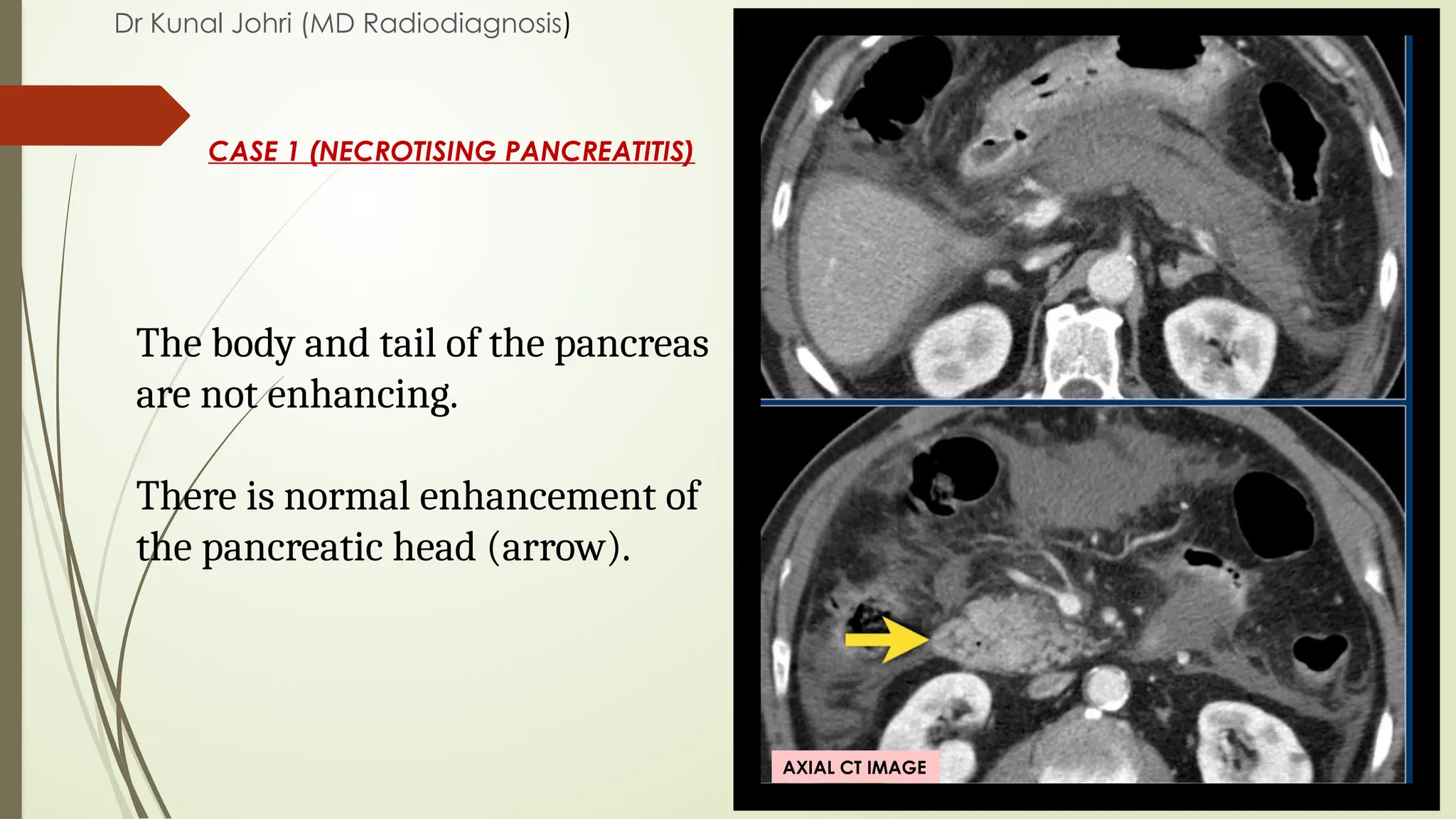 Imaging in Acute Pancreatitis | PPTX