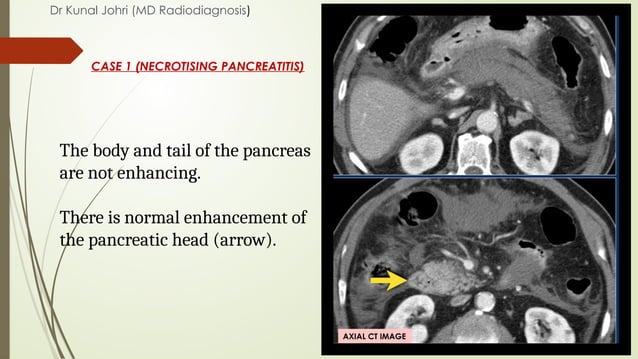 Imaging in Acute Pancreatitis | PPTX | Endocrine and Metabolic Diseases ...