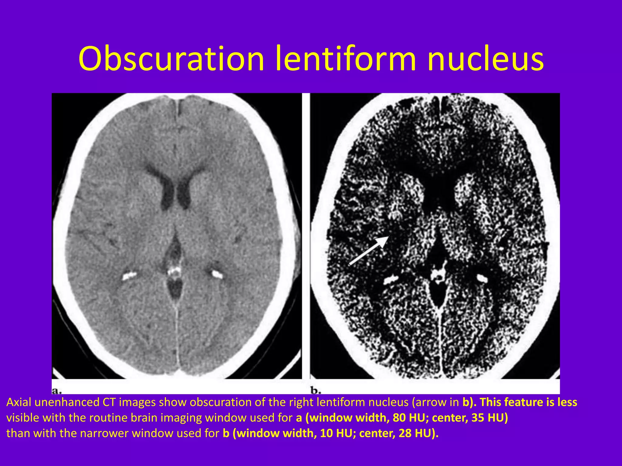 Imaging in acute stroke | PPTX