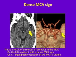 Dense Mca Sign