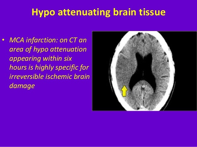 Imaging in acute stroke